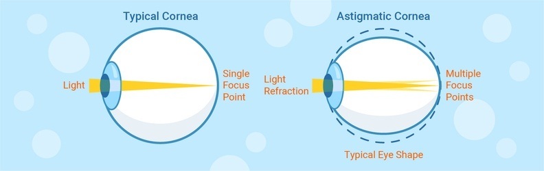 Wat is astigmatisme? Definitie, symptonen, diagnose en behandeling ...